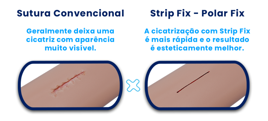 Curativo Tiras Para Sutura Estéril Strip Fix – Polar Fix